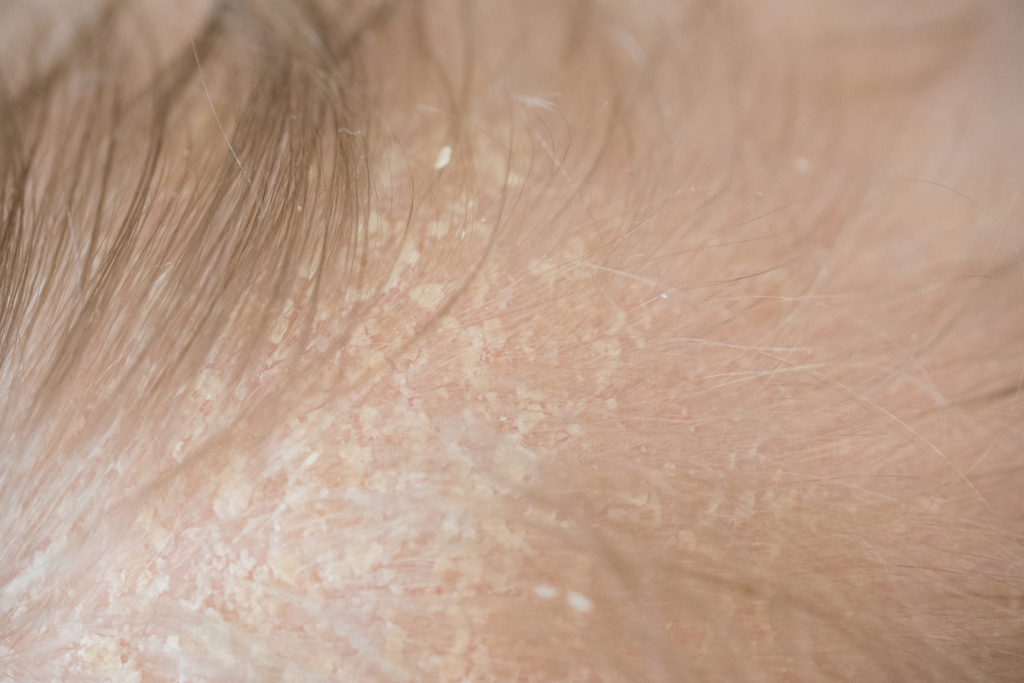 Milchschorf: Symptome, Ursachen, Behandlung