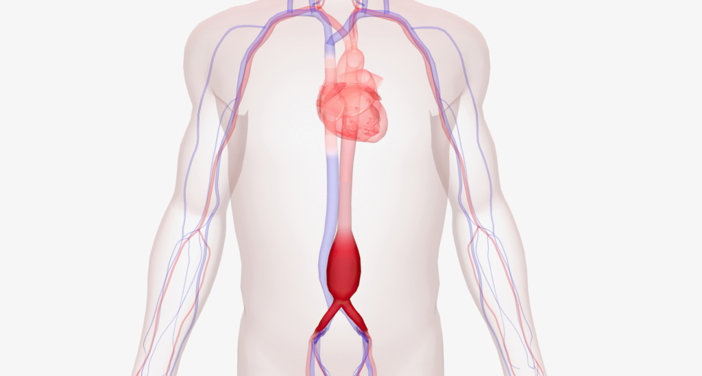 Bauchaortenaneurysma: Symptome, Ursachen, Behandlung