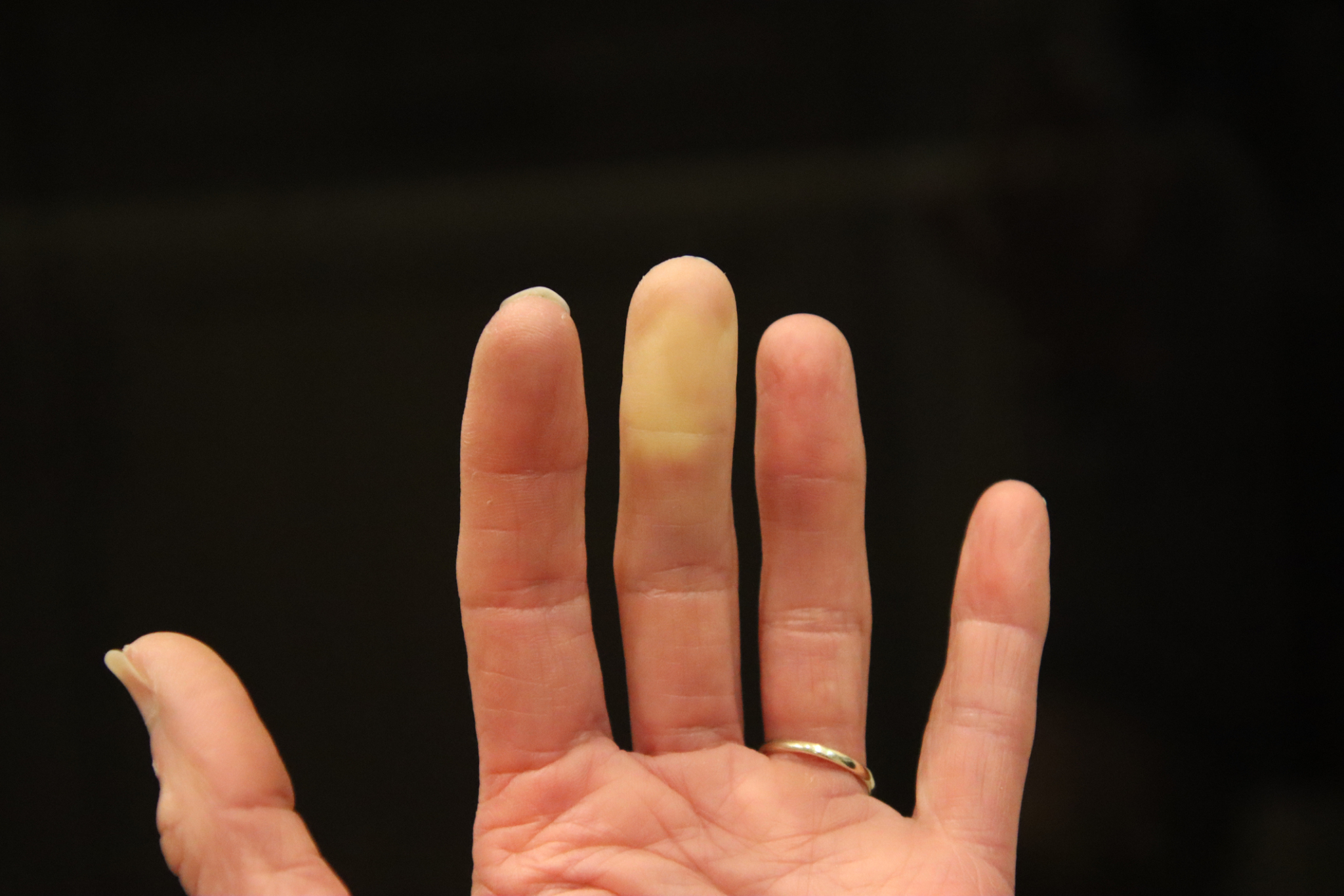 Raynaud-Syndrom: Symptome, Ursachen, Behandlung